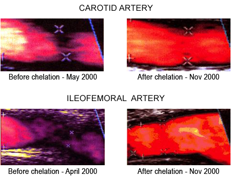 Chelation Therapy Edmonton | Optimum Wellness Integrated